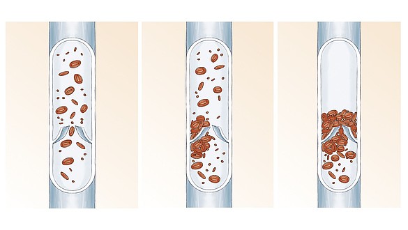 Thrombose veineuse profonde