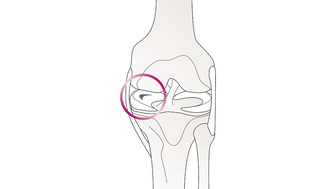 Blessure du ménisque